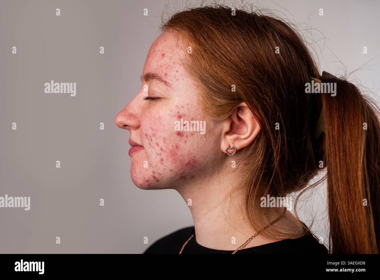 Many pimples. Girl with bad skin. Hormonal acne, puberty. Skin acne ...