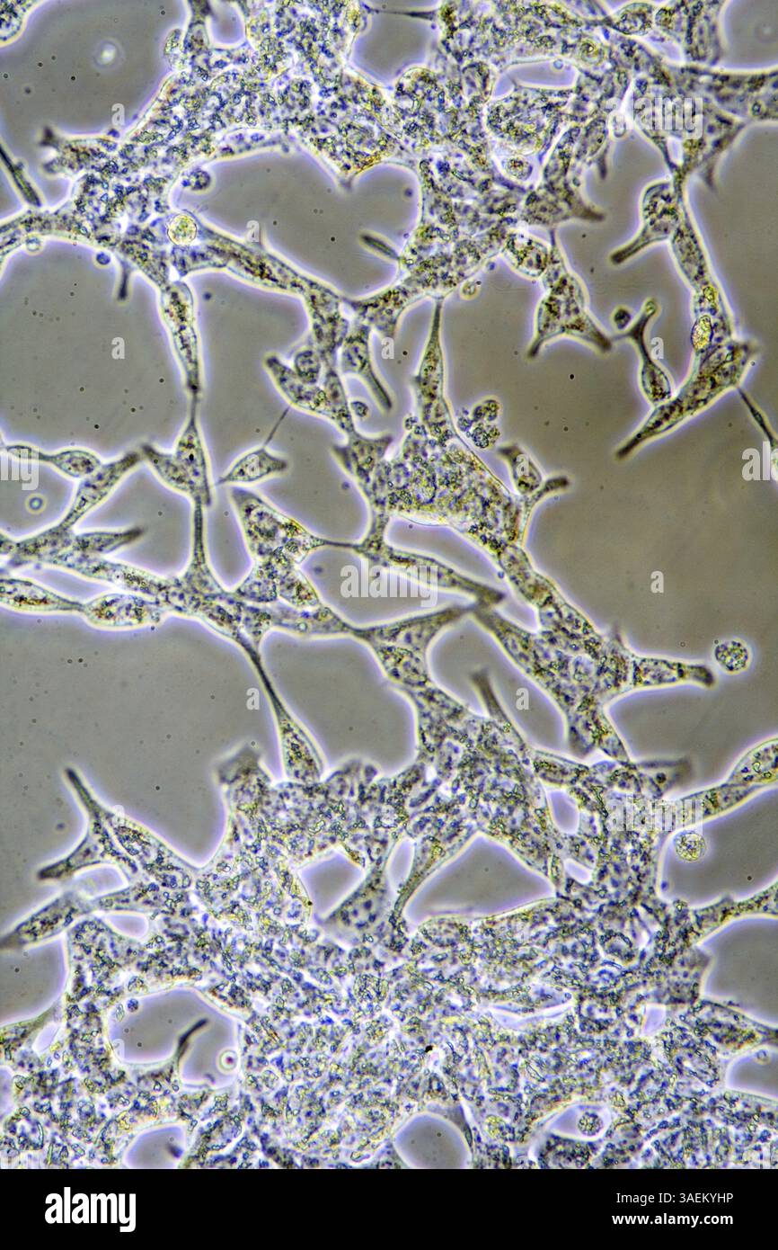 Microscope view of mens health Prostate Cancer cells in tissue culture ...