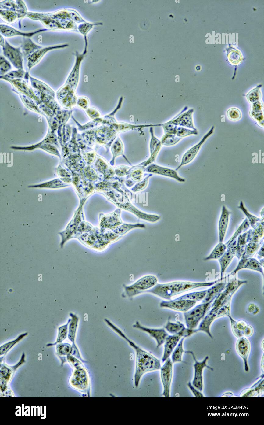 Microscope view of mens health Prostate Cancer cells in tissue culture ...