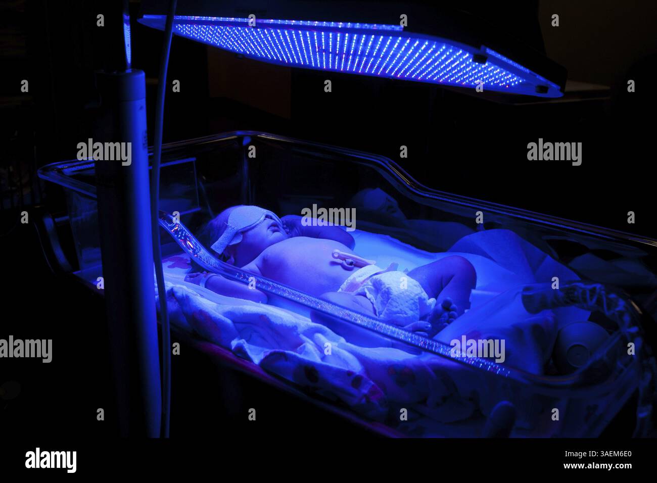 Newborn baby with neonatal jaundice and high bilirubin ...