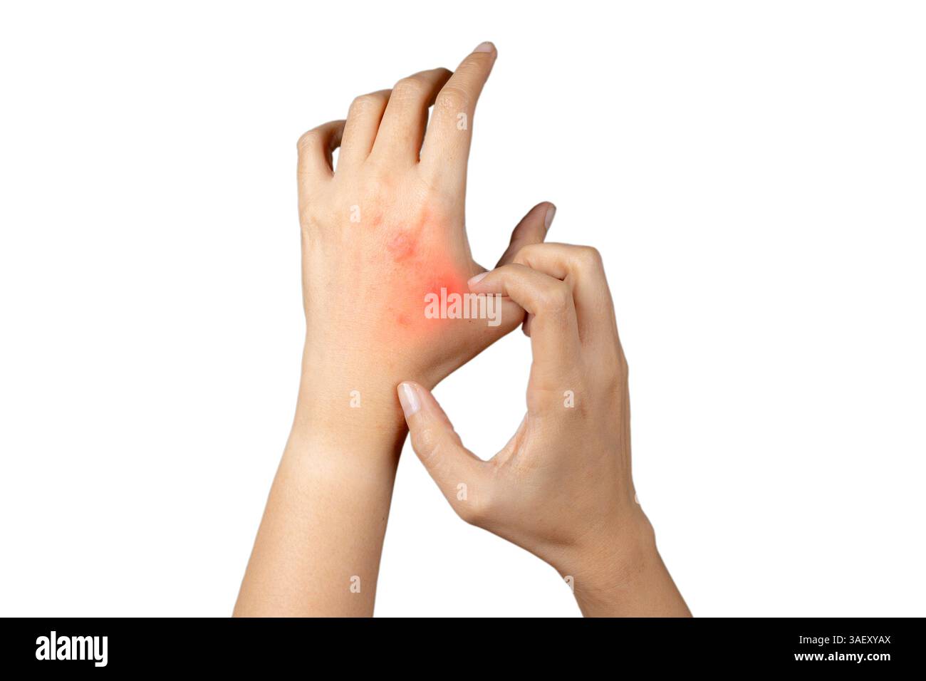 Eczema dermatitis on hands. red spots on the skin. dry skin The concept ...