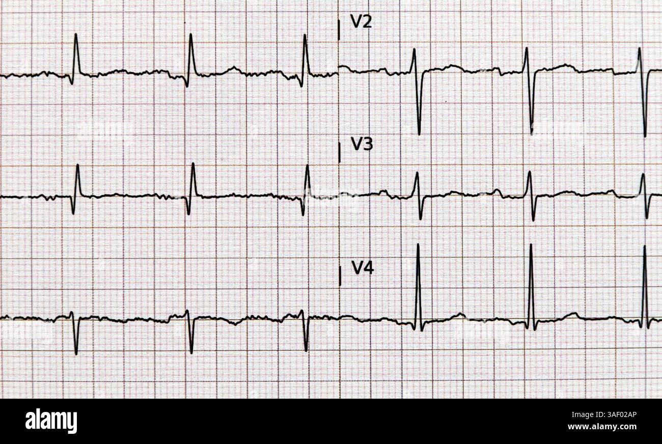 Close-up of a standard electrocardiogram, EKG, graph paper. Health and ...