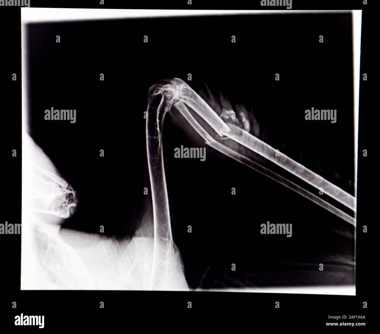 Palm fractures hi-res stock photography and images - Alamy