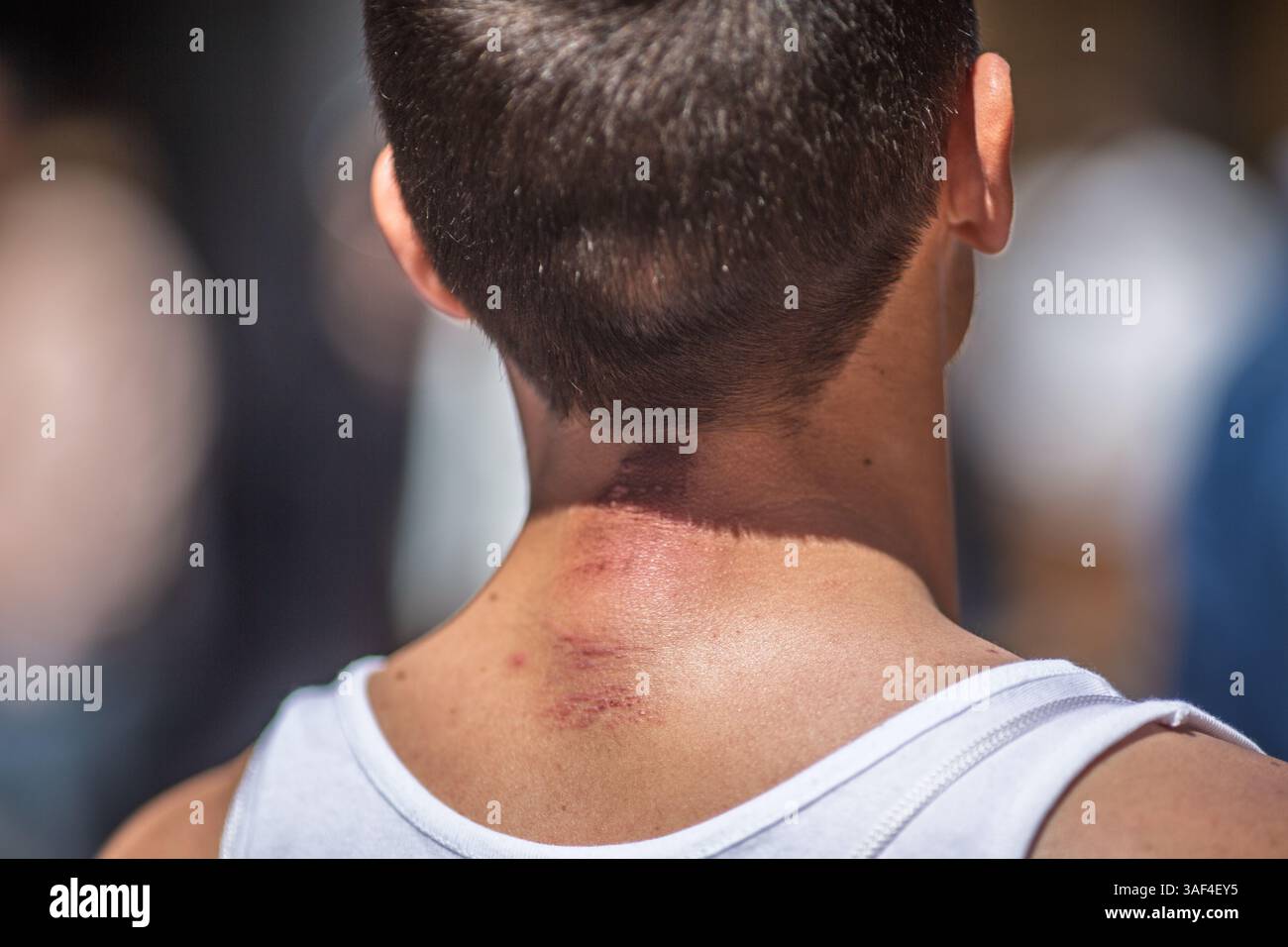 Close-up of red marks on a young costalero's back during Holy Week ...