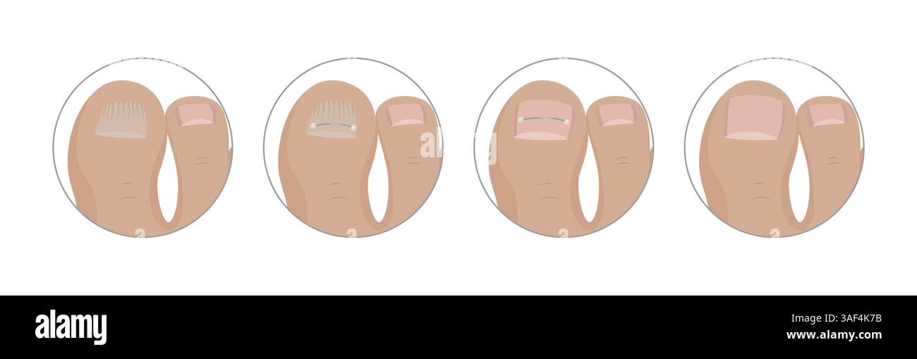 Correcting ingrown toenail with titanium thread, podiatrist performs ...