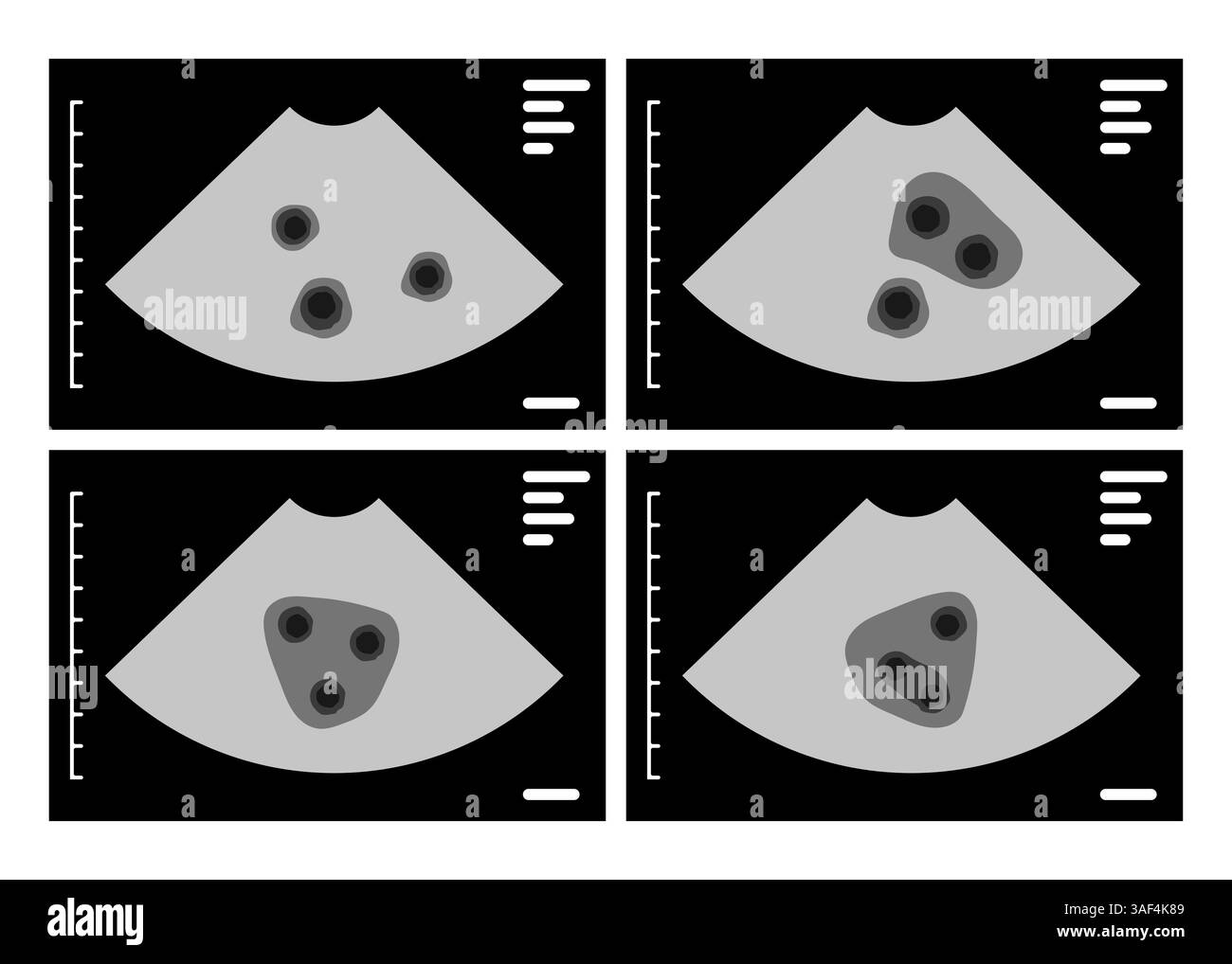 Four ultrasound images capturing three fetuses developing during ...