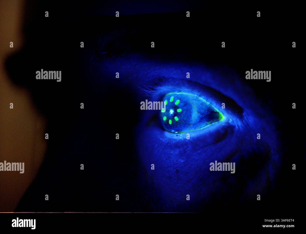 The newly corrected eye of Harry Constance (CQ) of San Diego is ...