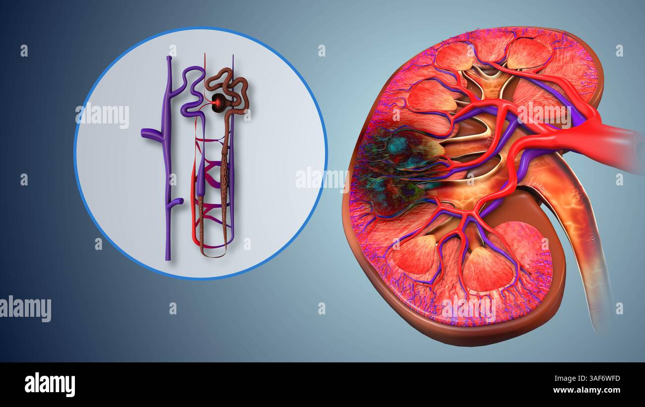 Nephron Damage Leading to Kidney Function Impairment Stock Photo - Alamy