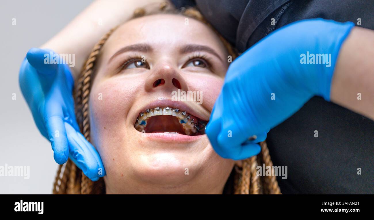 Dental procedure for installing braces close up. Dentistry. Braces on ...