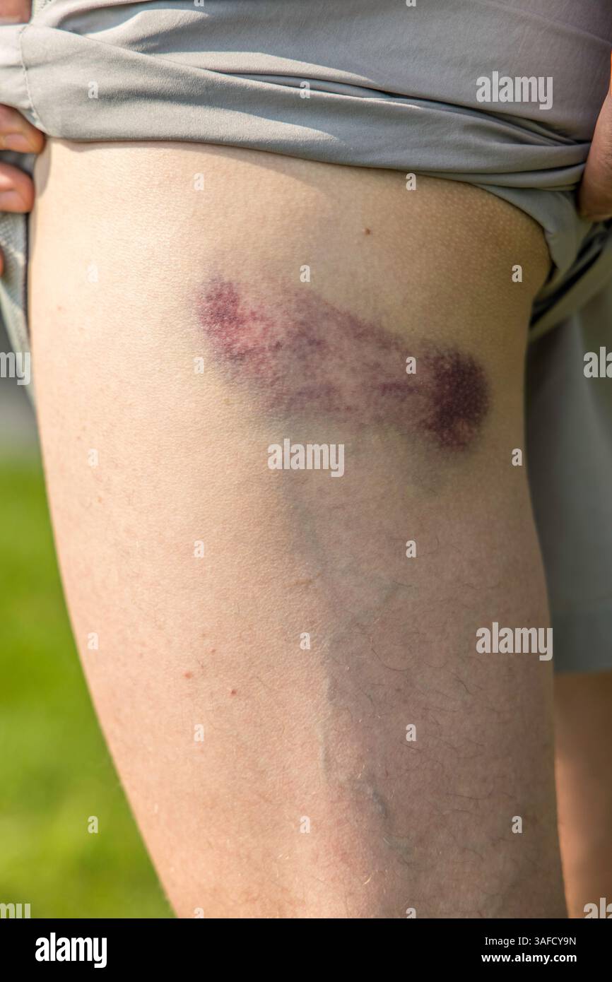Skin bruise texture hi-res stock photography and images - Alamy