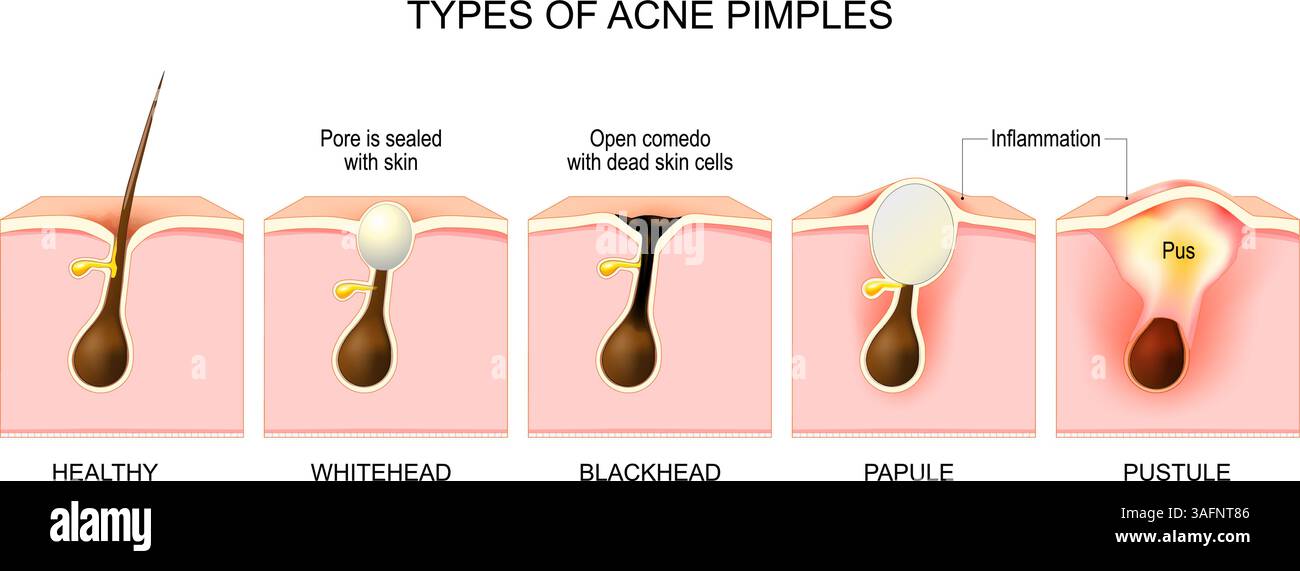 Types of acne pimples. Cross section of a healthy human skin and hair follicle. Pus and ...