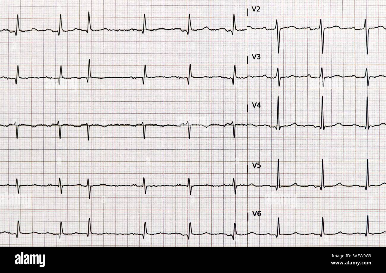 Detailed EKG, electrocardiogram showing heartbeat patterns Stock Photo ...