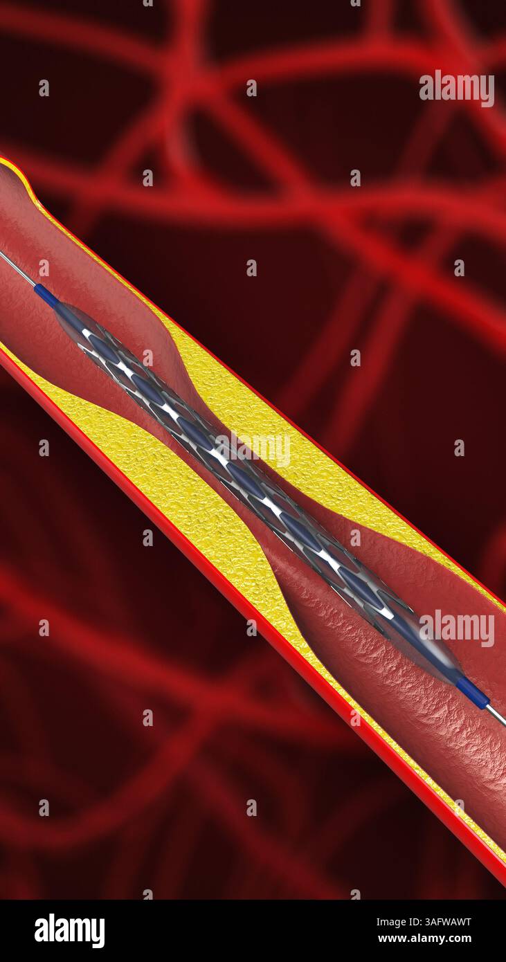 3D Medical Of Balloon Stent Angioplasty Procedure Stock Photo - Alamy