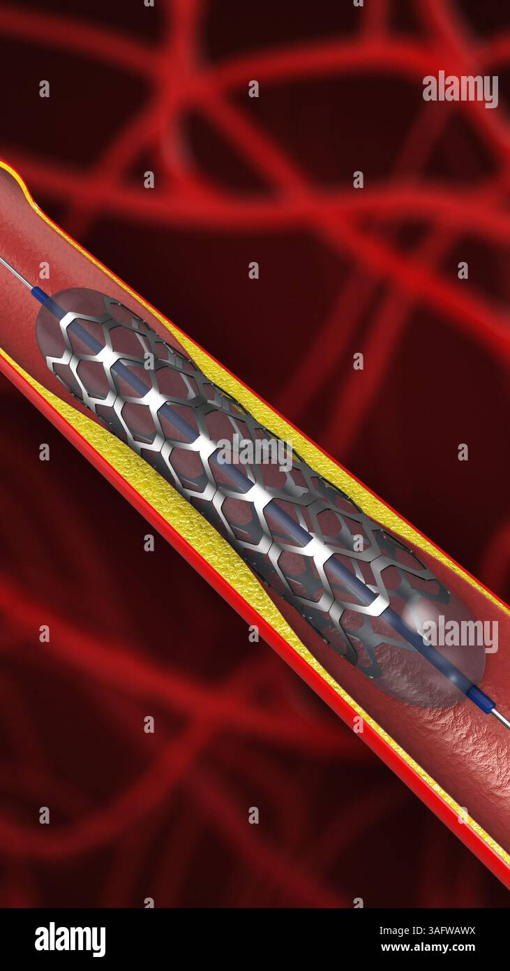 3D Medical Of Balloon Stent Angioplasty Procedure Stock Photo - Alamy