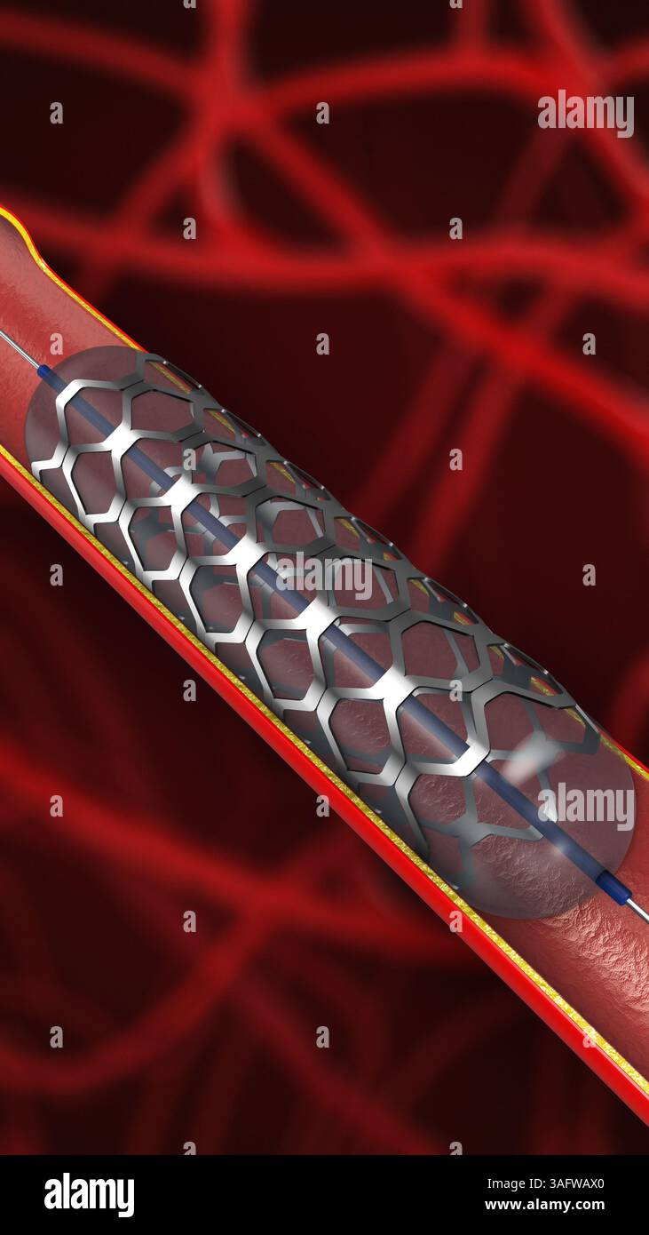 3D Medical Of Balloon Stent Angioplasty Procedure Stock Photo - Alamy
