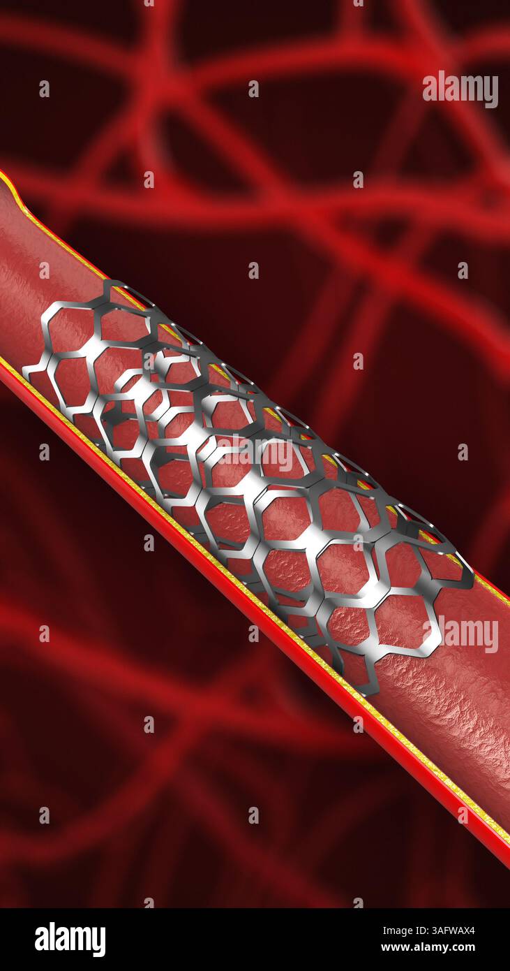 Angioplasty and Stent Placement for the Heart Stock Photo - Alamy