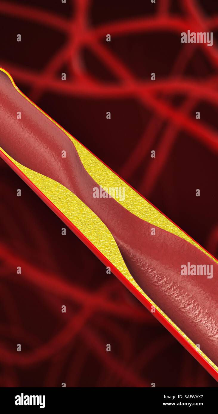 Blocked blood vessel artery with cholesterol Stock Photo - Alamy