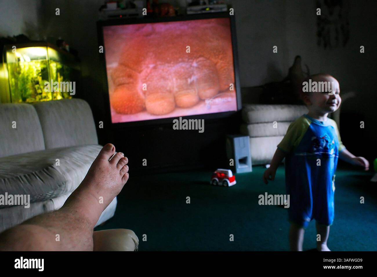 2) A television documentary on elephantitis shows the advanced stages ...