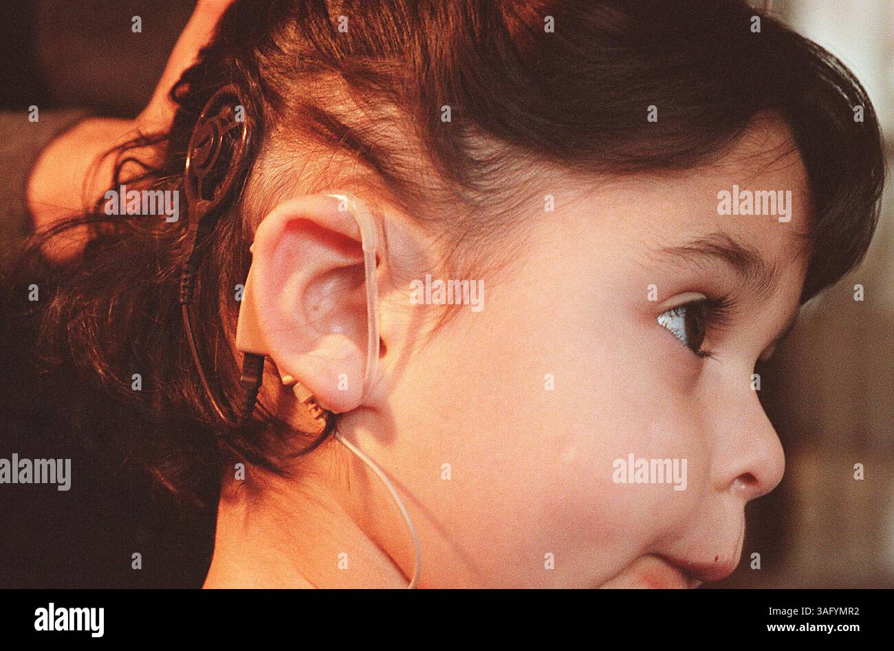 Rachel Knobel, 5, shows her cochlear implant. The implant consists of ...