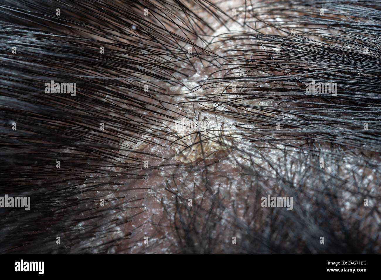 Macro of hair scalp asian human with black hairline have a problem with ...