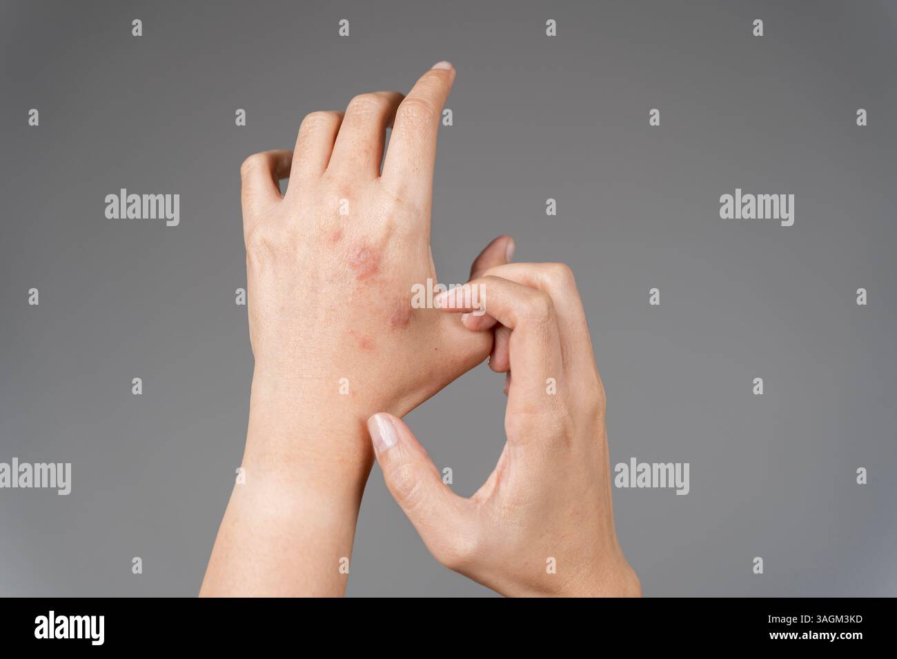 Women scratch the itch with hand, arm, itching. Concept with Healthcare ...