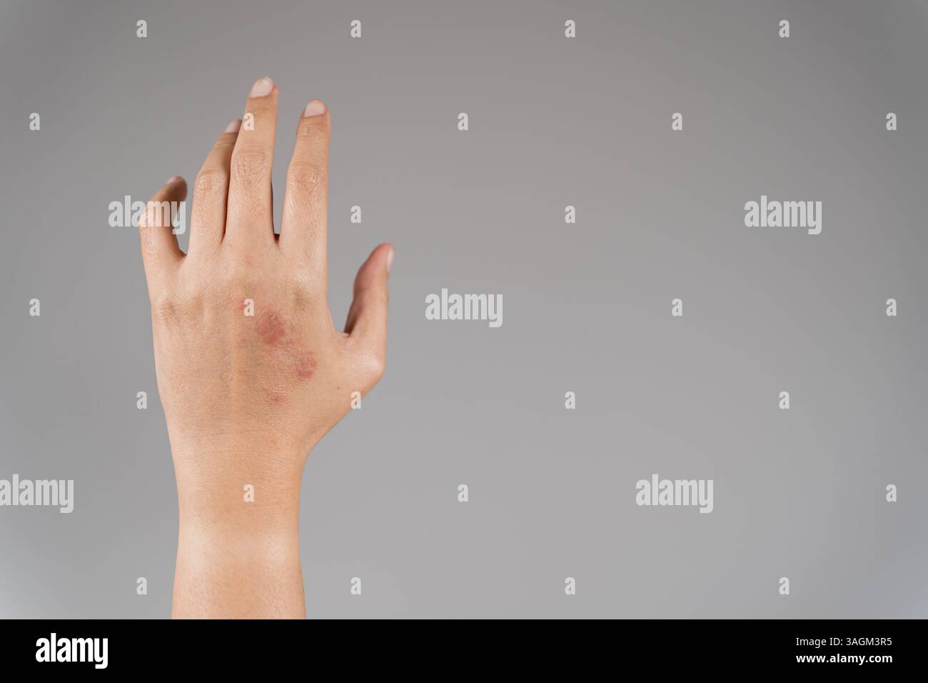 Close up allergic rash dermatitis eczema skin of patient wrist. Women ...