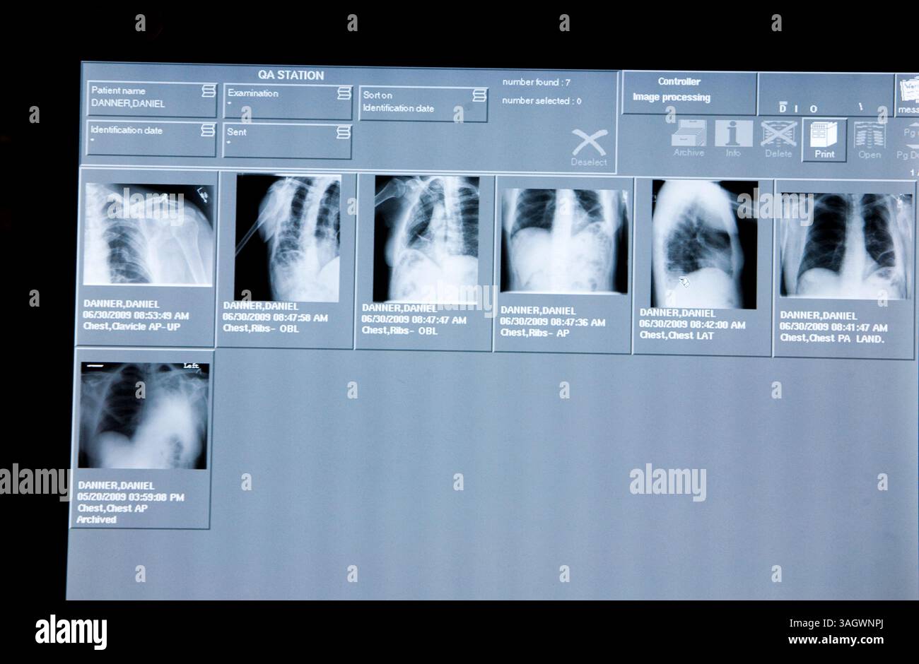 An x-ray of his lungs show on the bottom left how his lung had ...