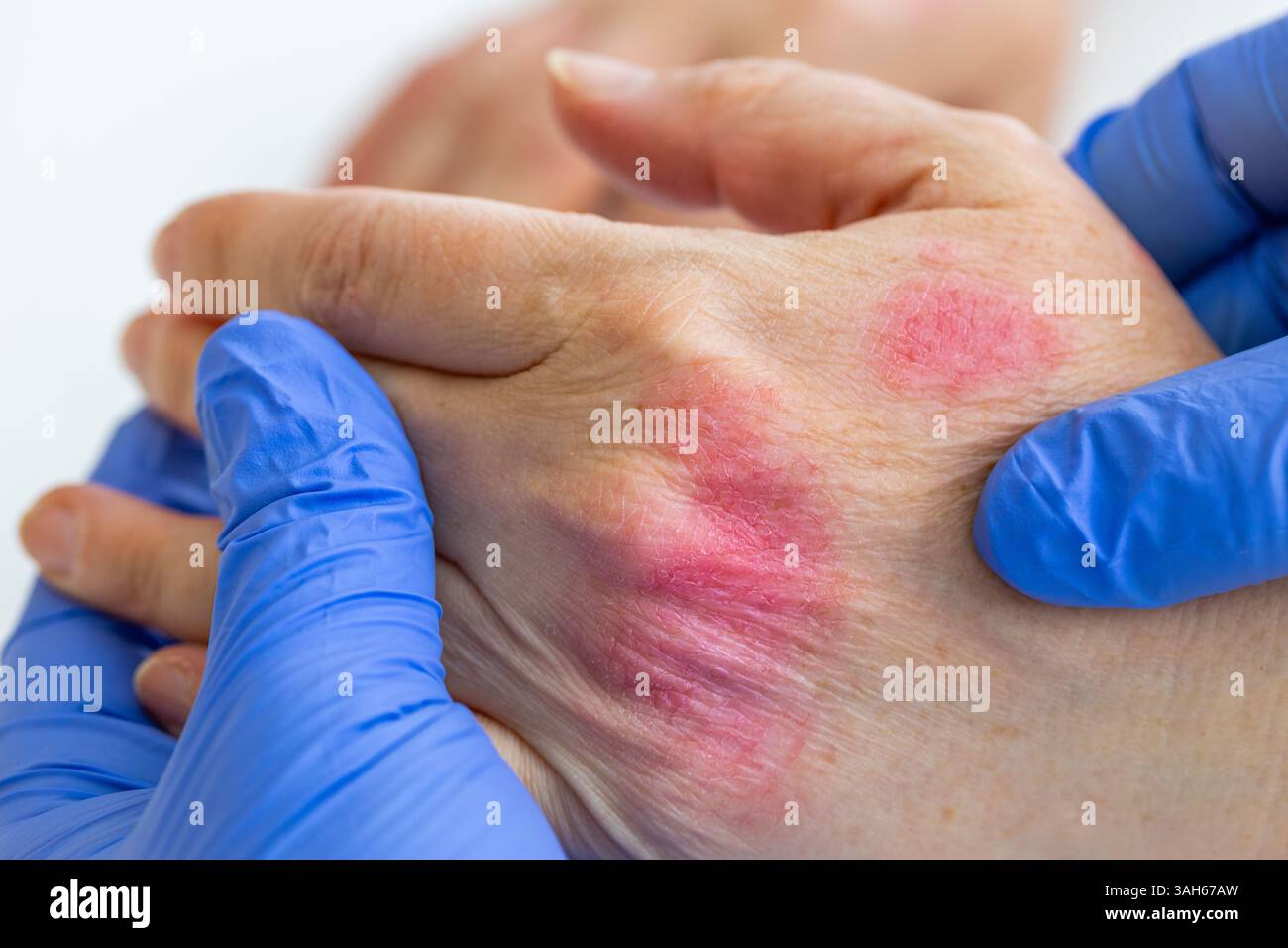 atopic dermatitis. red, itchy, woman's hands. Cracked skin and allergic ...