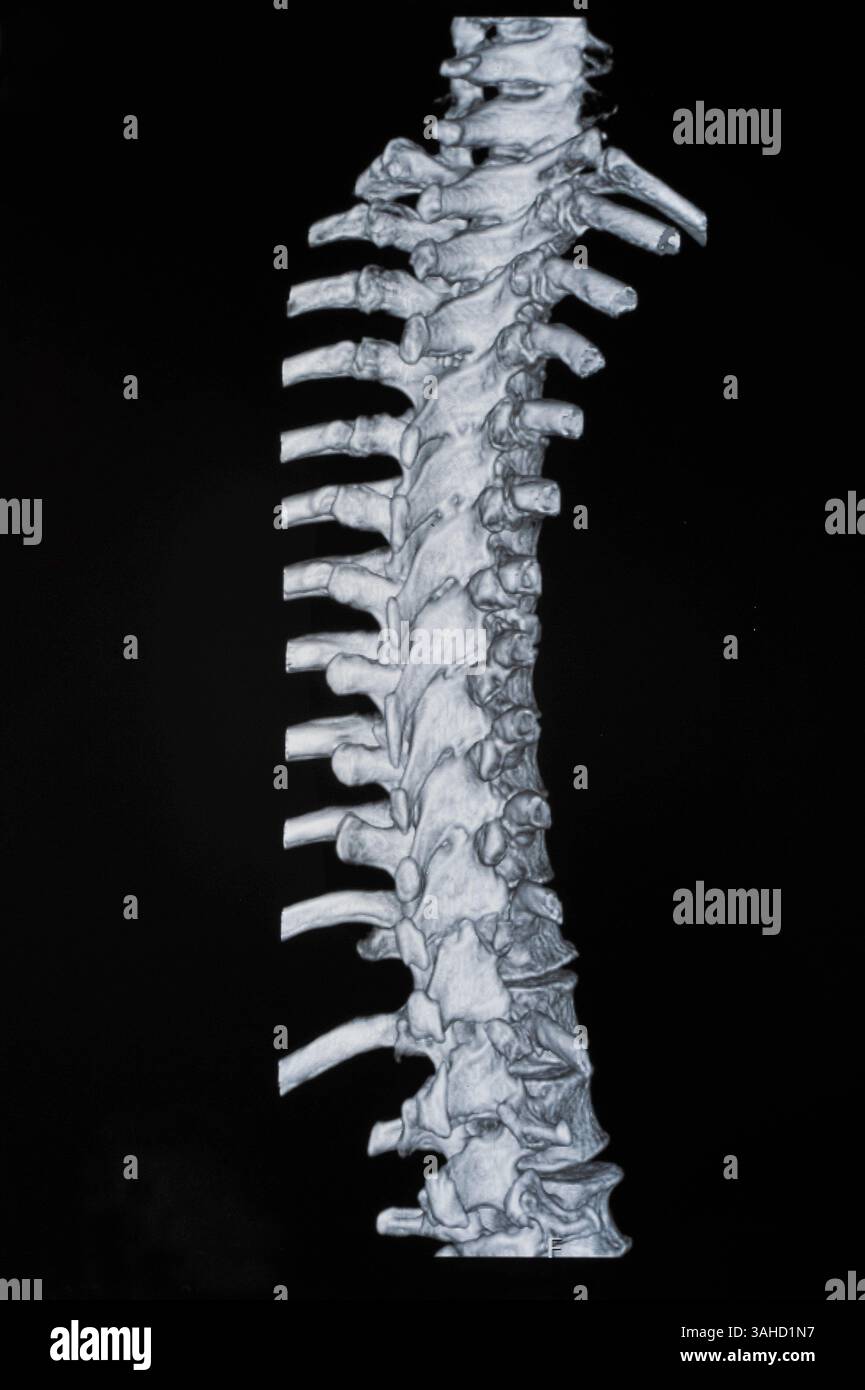 Spinal mri images Stock Photo - Alamy
