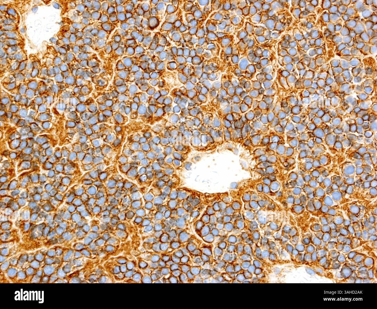 Ewing sarcoma of bone, light micrograph Stock Photo - Alamy
