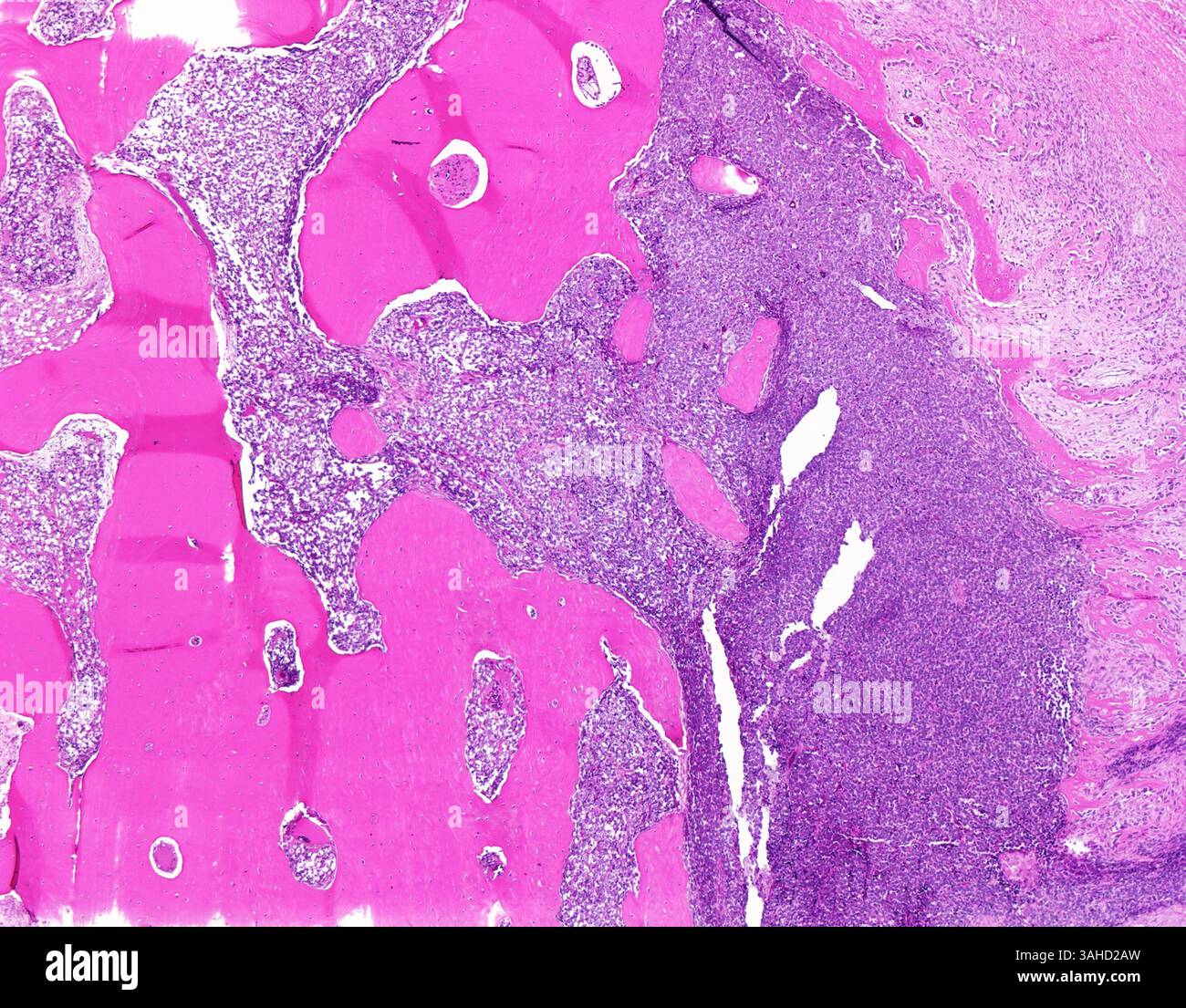 Ewing sarcoma of bone, light micrograph Stock Photo - Alamy