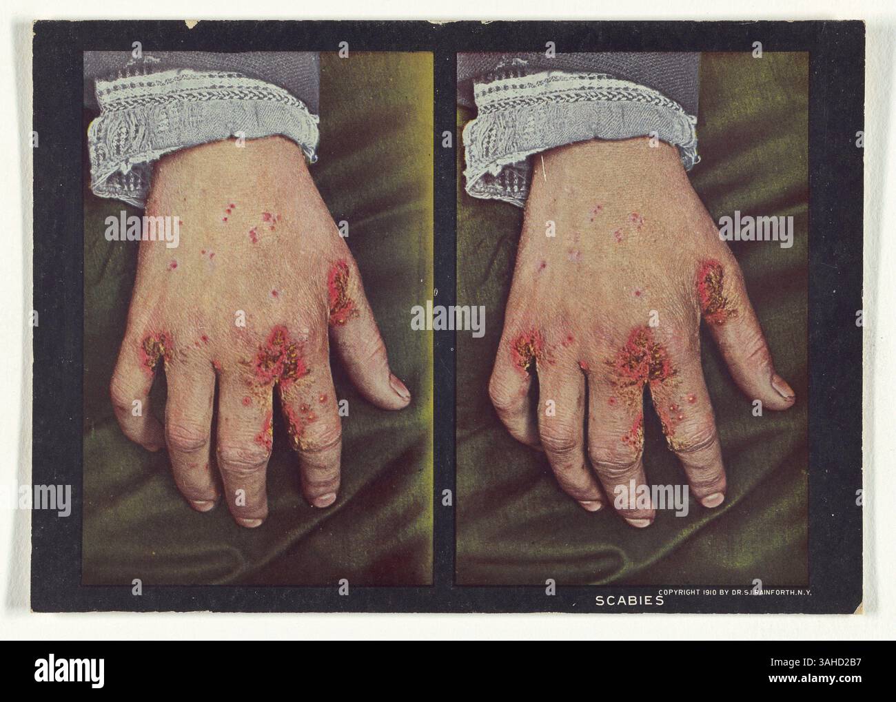 Coloured stereoscopic image of the hand of a patient infected with ...