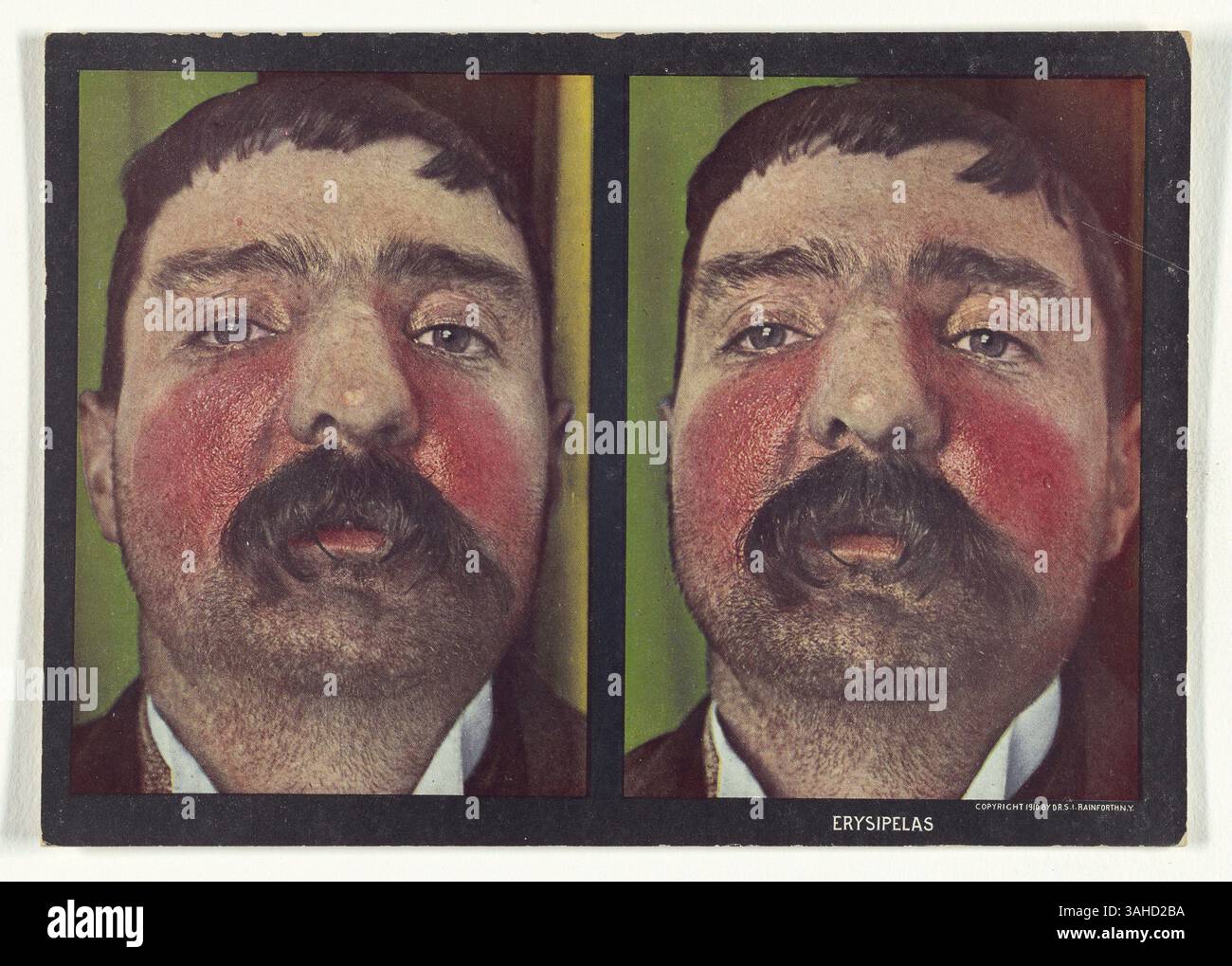 Coloured stereoscopic image of a man with erysipelas. Erysipelas is an ...