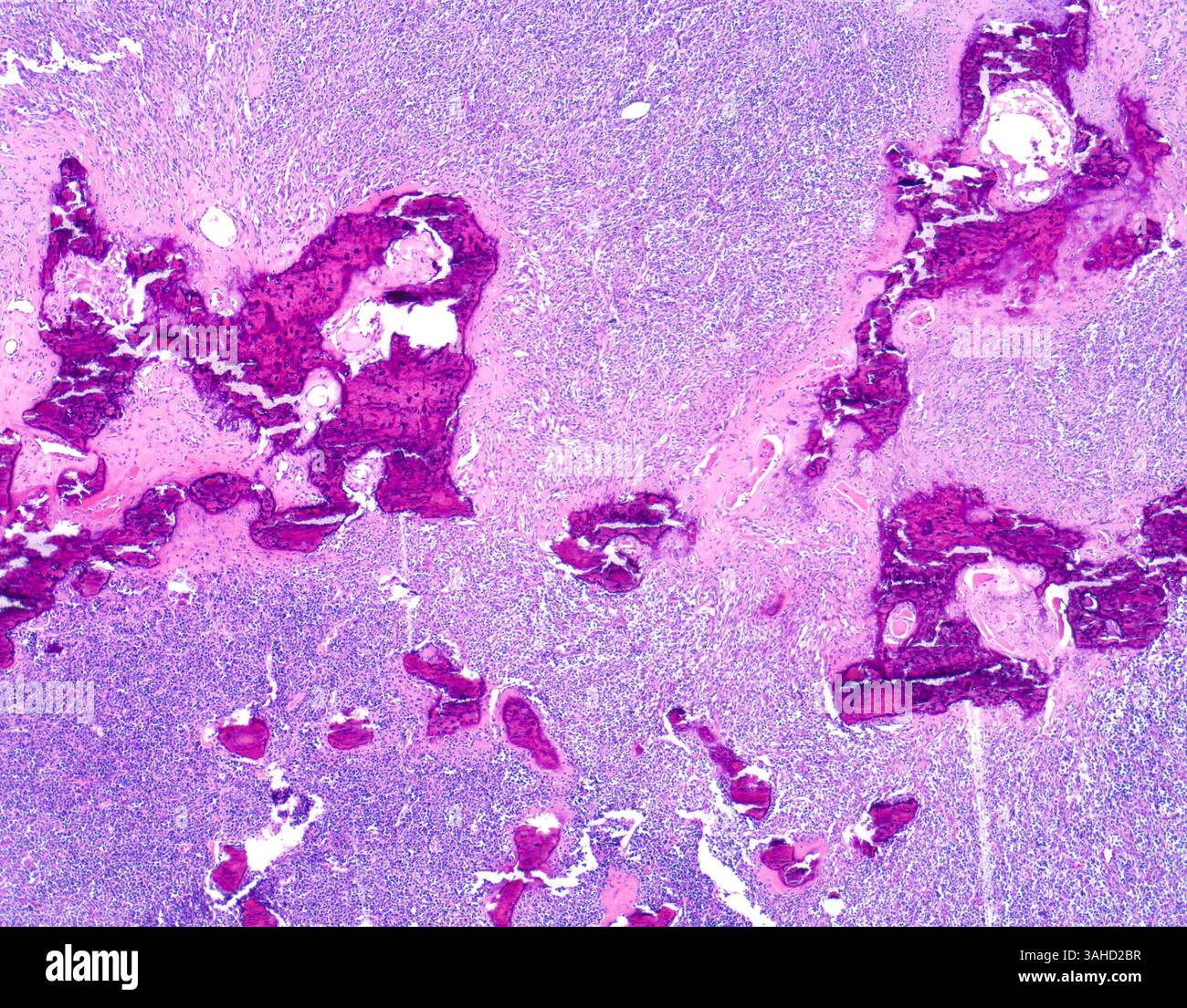 Ewing sarcoma of bone, light micrograph Stock Photo - Alamy