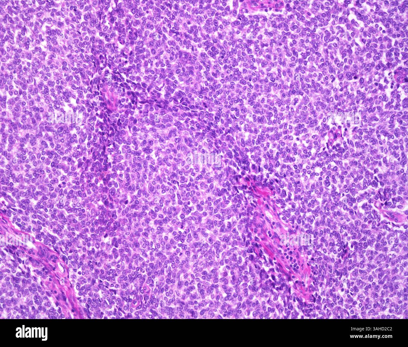 Ewing sarcoma of bone, light micrograph Stock Photo - Alamy