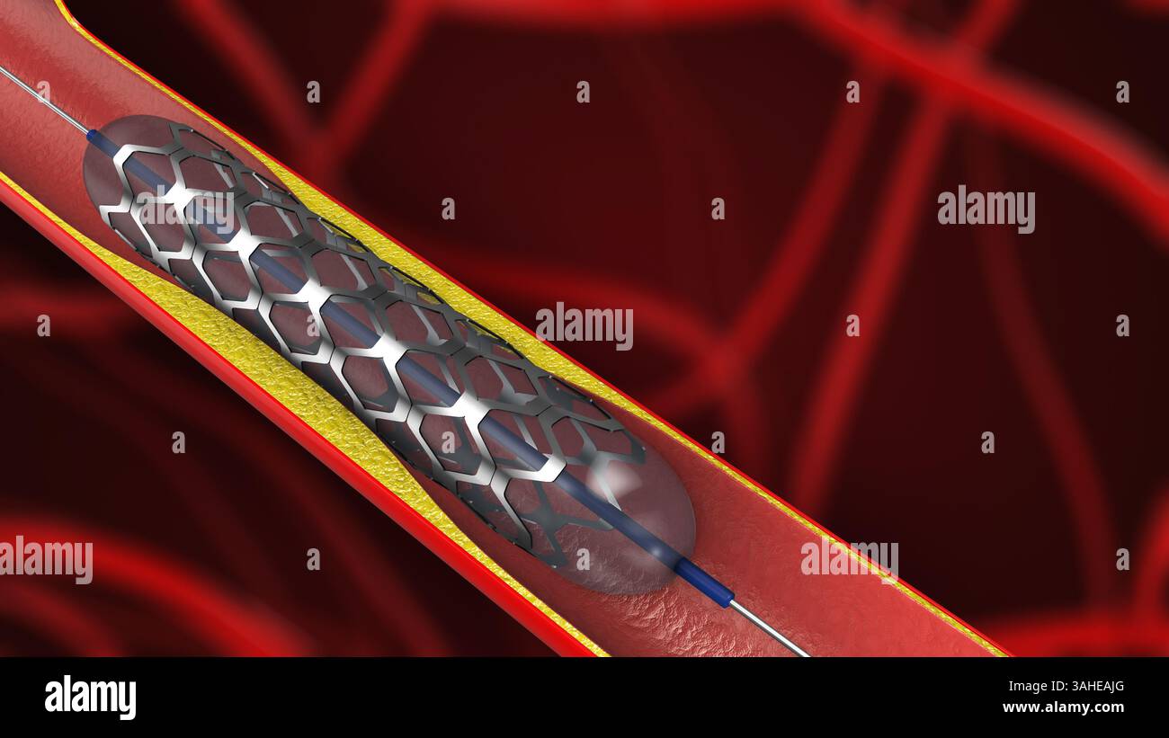 3D Medical Of Balloon Stent Angioplasty Procedure Stock Photo - Alamy