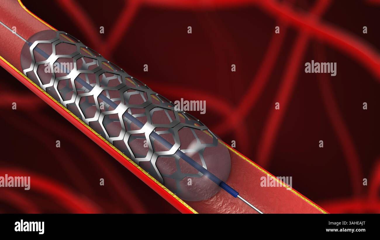 3D Medical Of Balloon Stent Angioplasty Procedure Stock Photo - Alamy