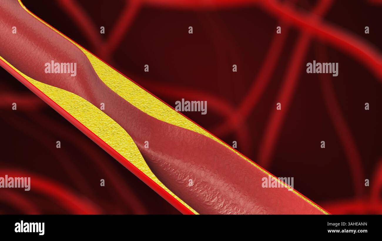 Blocked blood vessel artery with cholesterol Stock Photo - Alamy