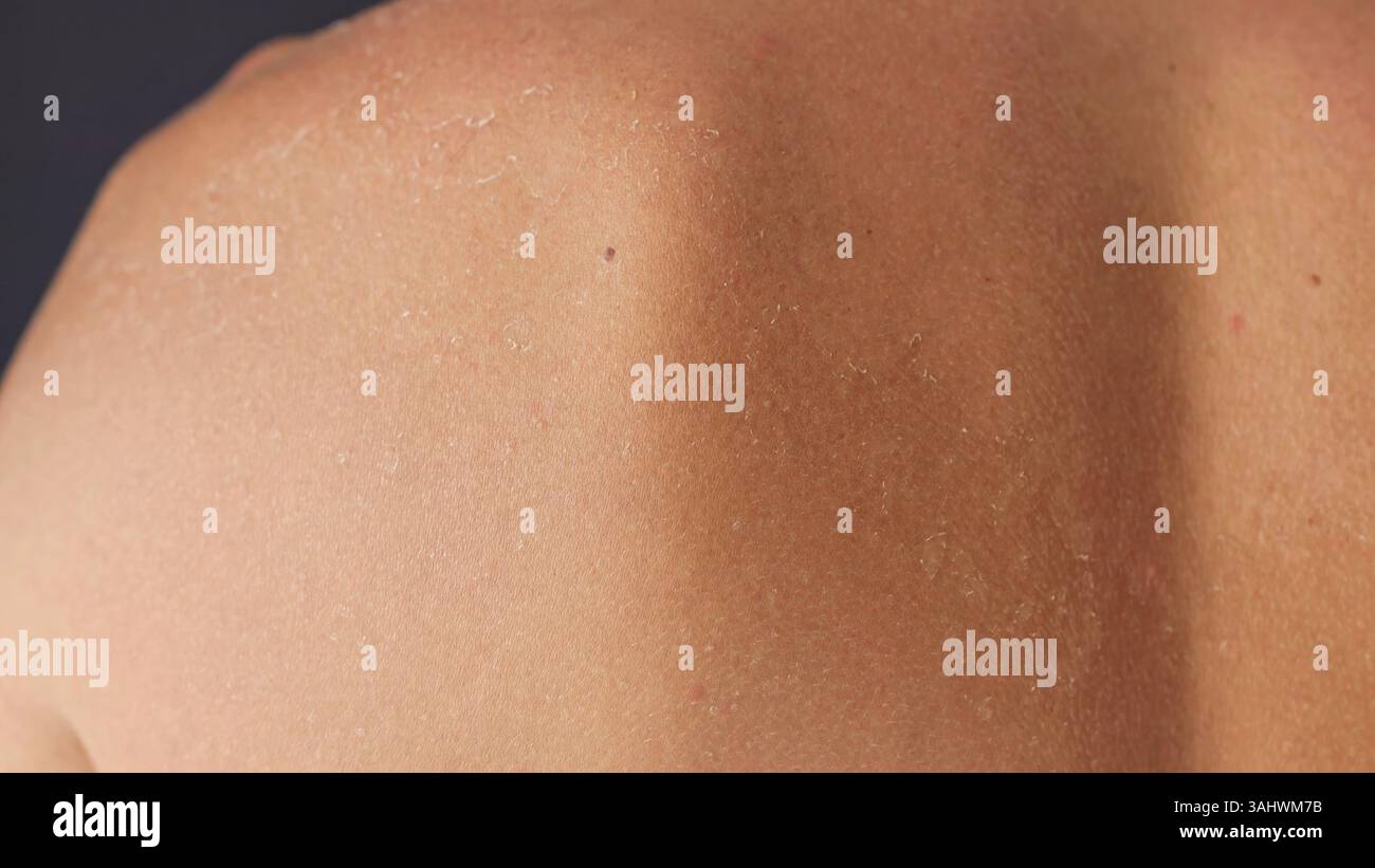 Sunburned skin on woman shoulder shows ocean beach rest Stock Photo - Alamy