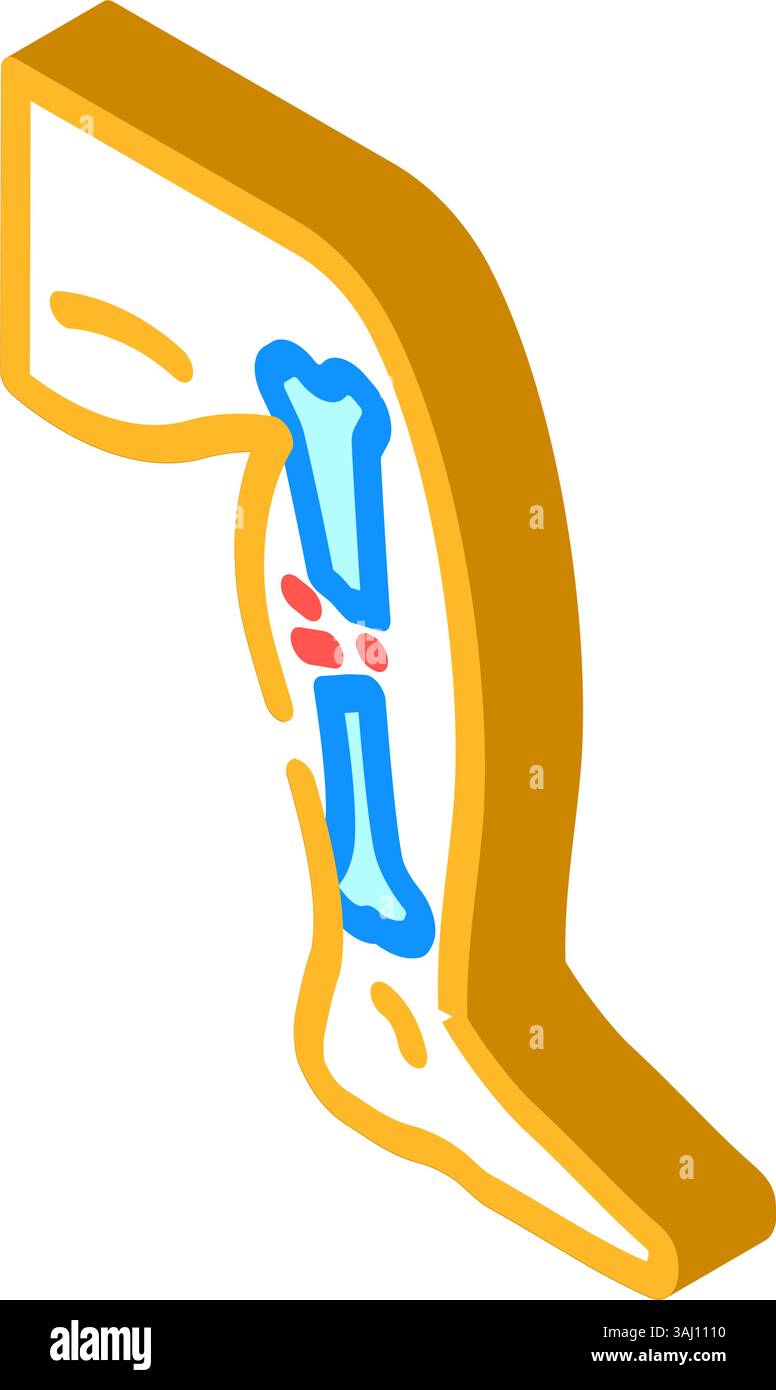 broken leg fracture injury isometric icon vector illustration Stock ...