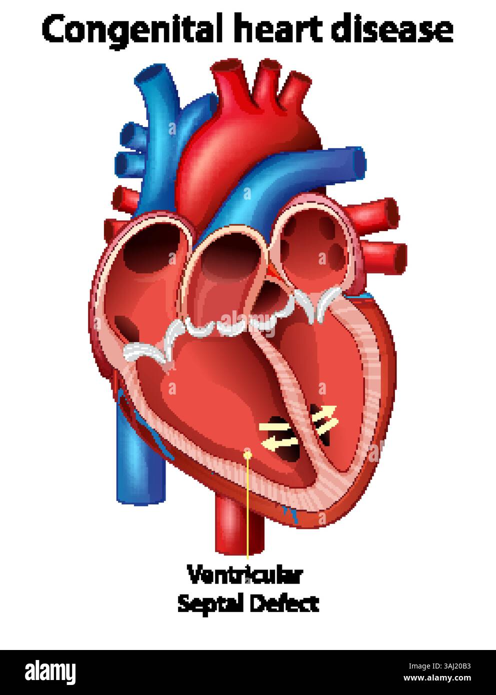 Detailed vector illustration of a human heart with ventricular septal ...