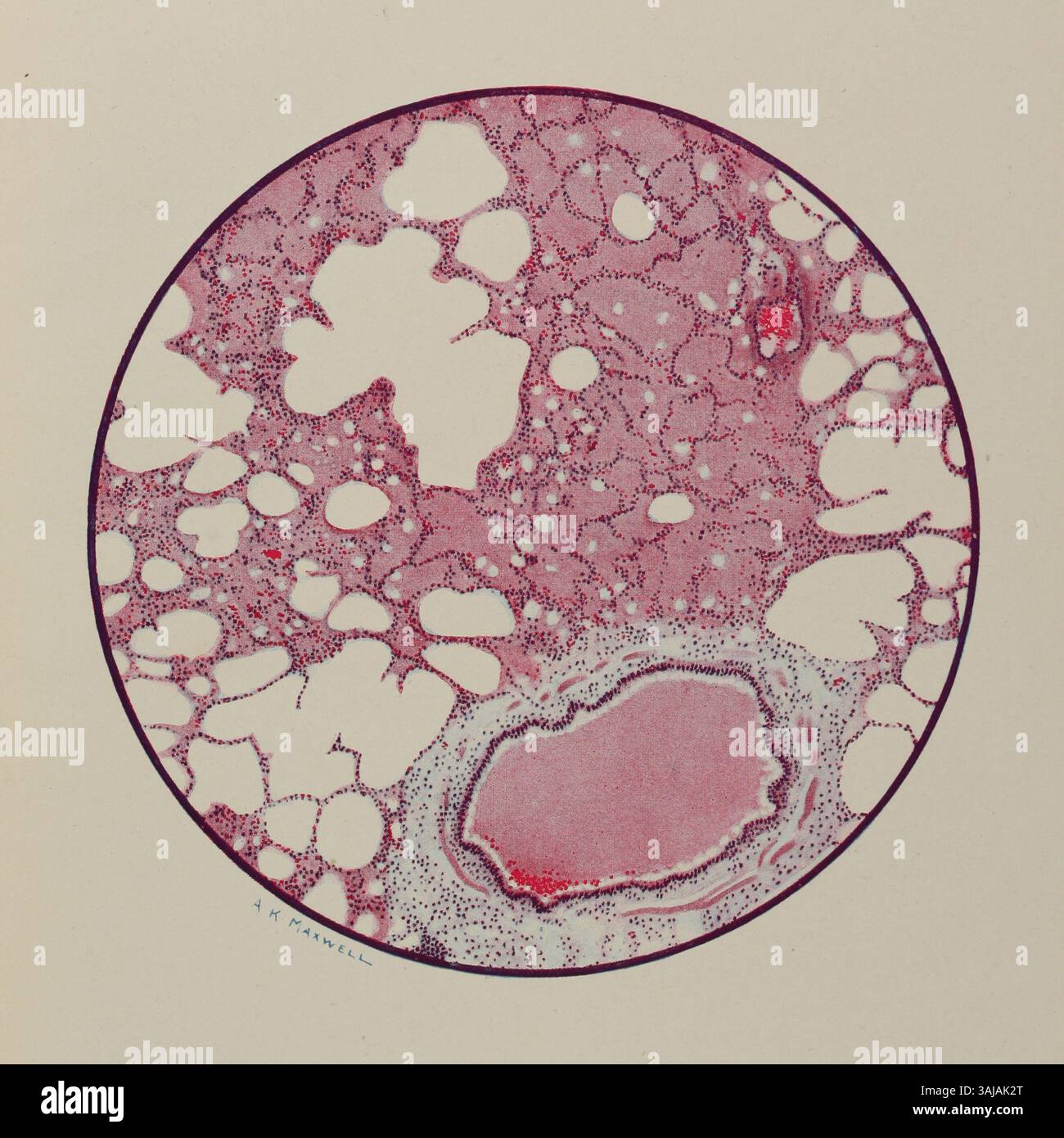 Plate I from 'An Atlas of Gas Poisoning' (1918) shows a microscopic ...