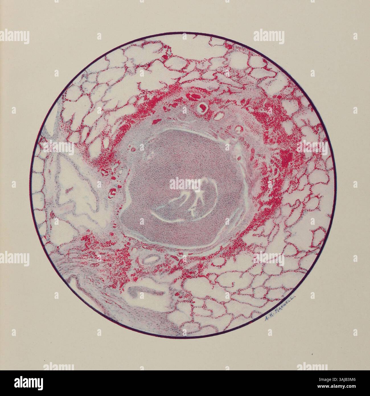 Plate X from 'An Atlas of Gas Poisoning' (1918) shows a microscopic ...