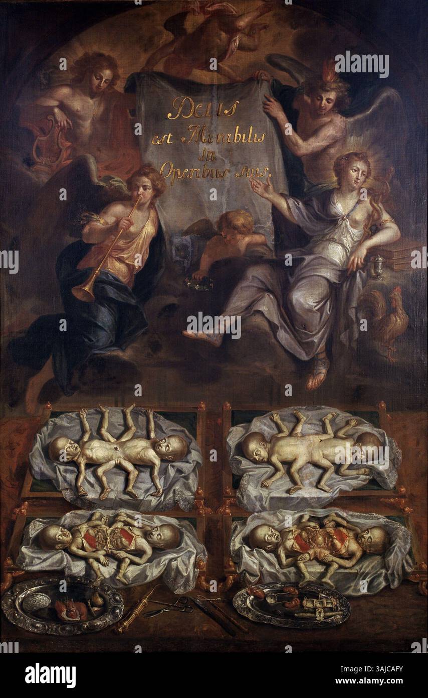 Norbert Sauvage's 1703 oil painting depicts the dissection of Siamese ...