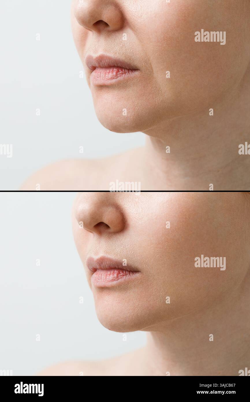 Female nasolabial fold before and after wrinkle smoothing procedures ...