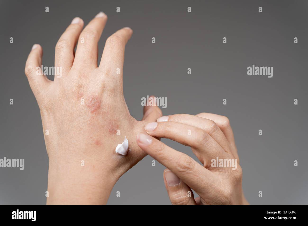A woman is applying anti-itch cream to her wrist uses ointments, creams ...