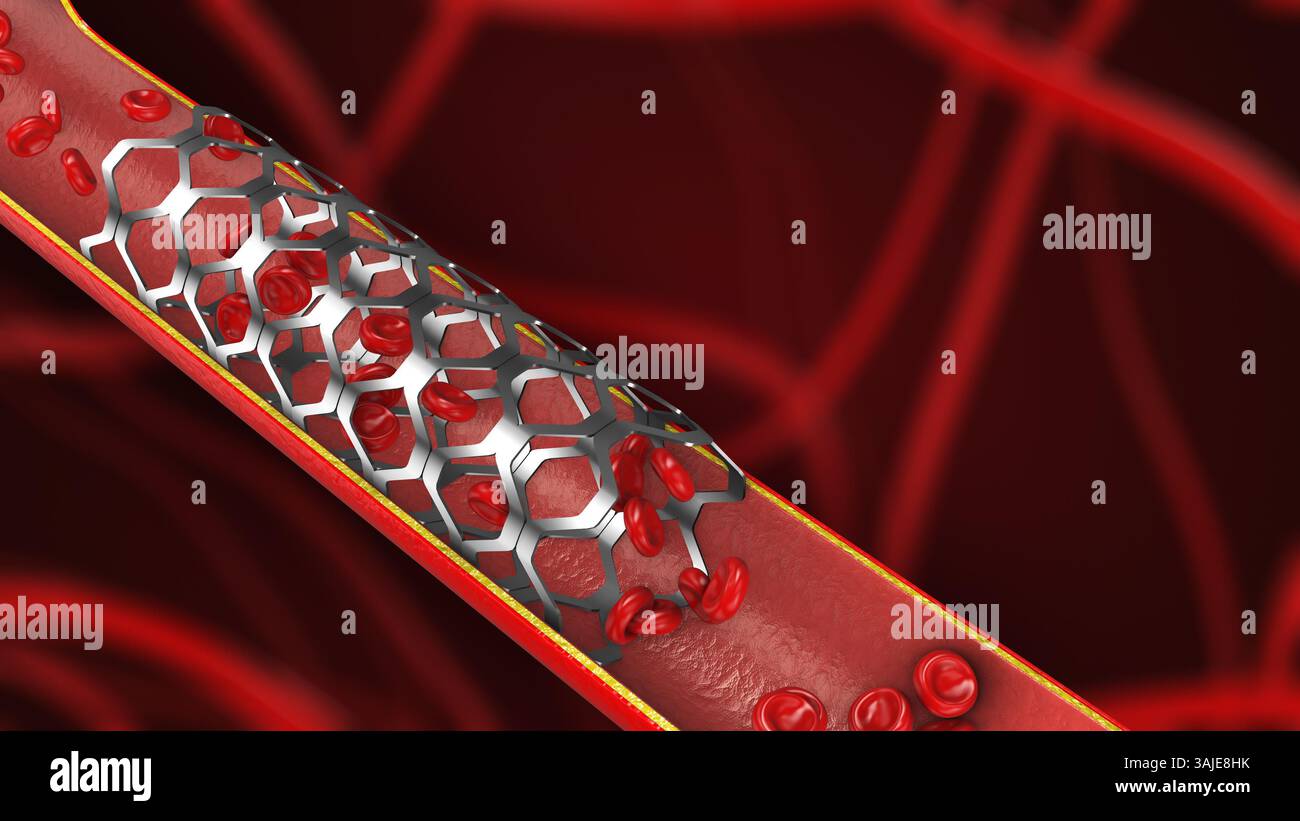 Artery Blockage Treatment with Blood Cells Flow Stock Photo - Alamy