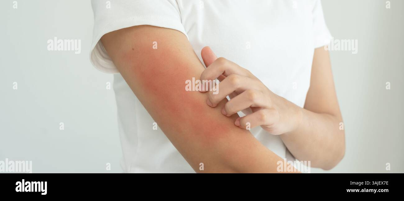 skin problem and beauty. Young woman scratch body has itchy skin from ...