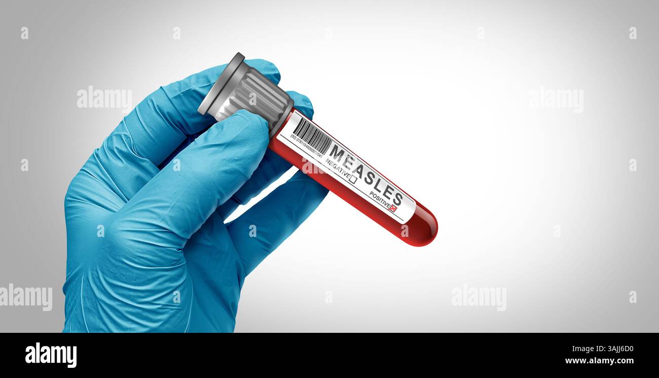 Measles Diagnosis as a Doctor or nurse holding a virus positive Blood ...