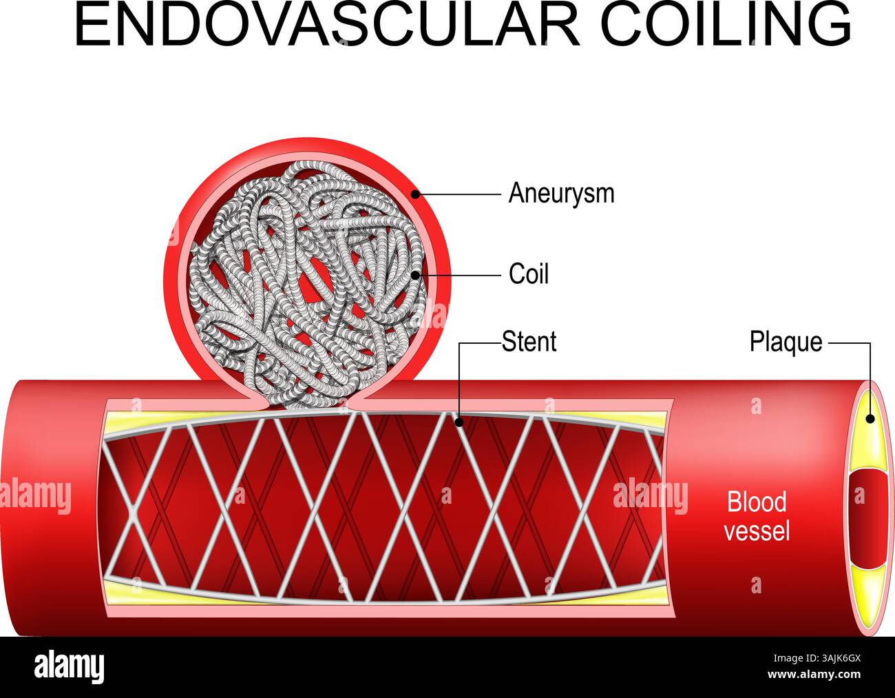 Endovascular coiling. Cross section of Blood vessel with ...